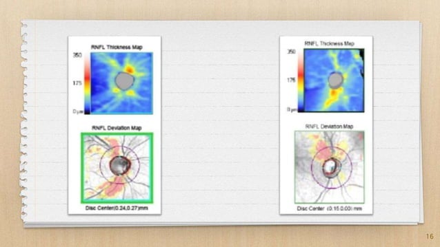 Interpretation of OCT(Glaucoma) | PPTX