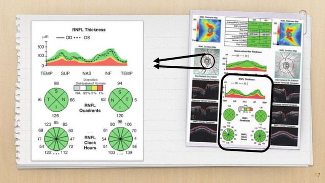 Interpretation of OCT(Glaucoma) | PPTX