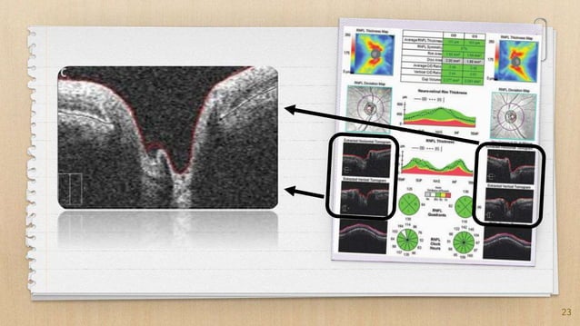 Interpretation of OCT(Glaucoma) | PPTX