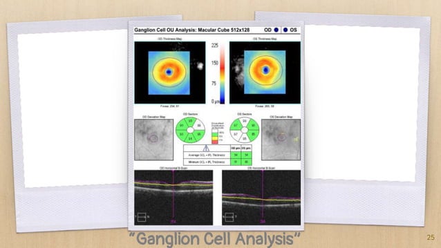 Interpretation of OCT(Glaucoma) | PPTX