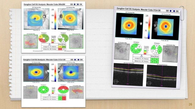 Interpretation of OCT(Glaucoma) | PPTX