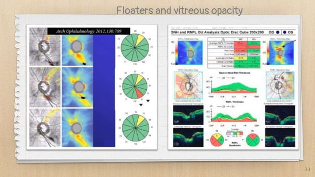 Interpretation of OCT(Glaucoma) | PPTX