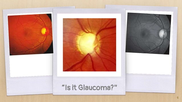 Interpretation of OCT(Glaucoma) | PPTX