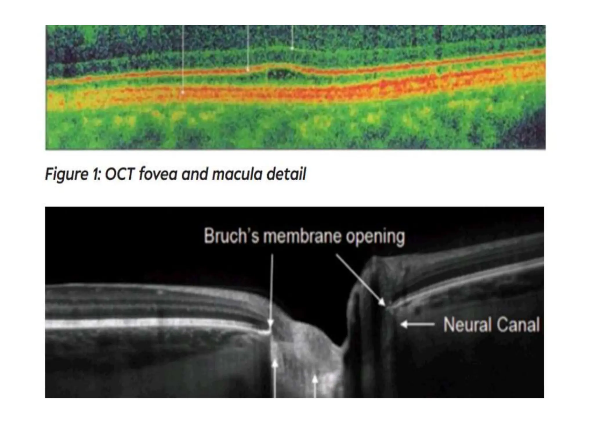 OPTICAL COHERENCE TOMOGRAPHY IN GLAUCOMA Presentation.pptx