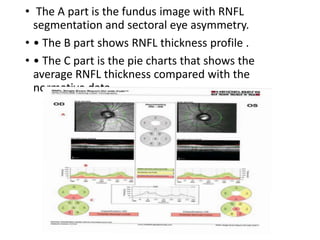 OPTICAL COHERENCE TOMOGRAPHY IN GLAUCOMA Presentation.pptx