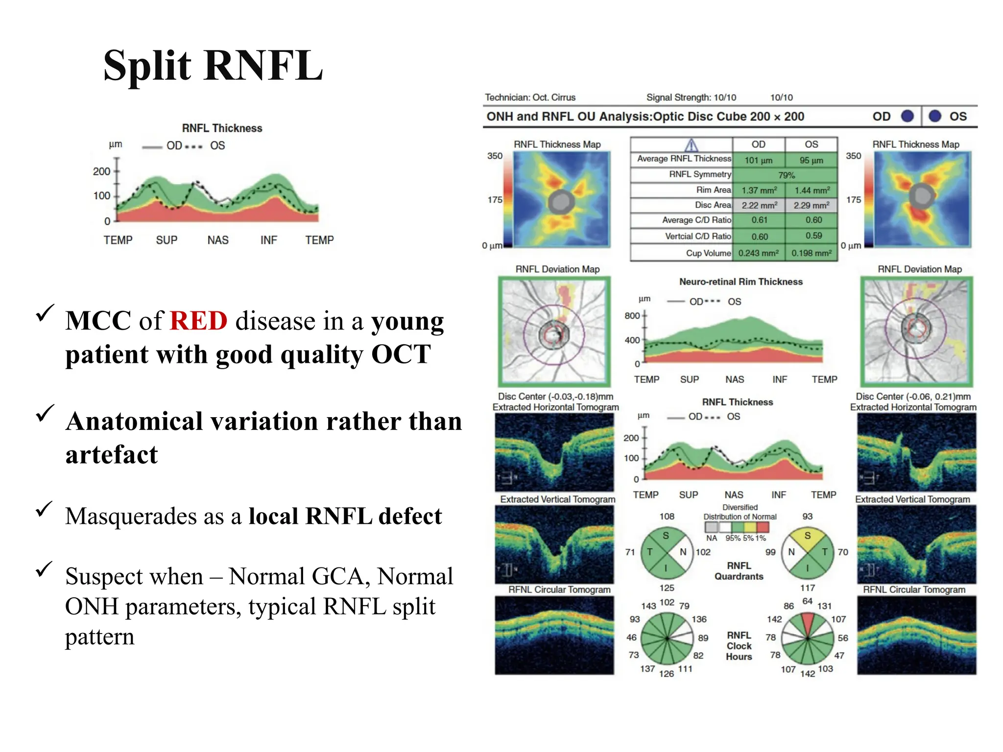 OCT in Glaucoma umesh- showing a Glaucoma | PPT