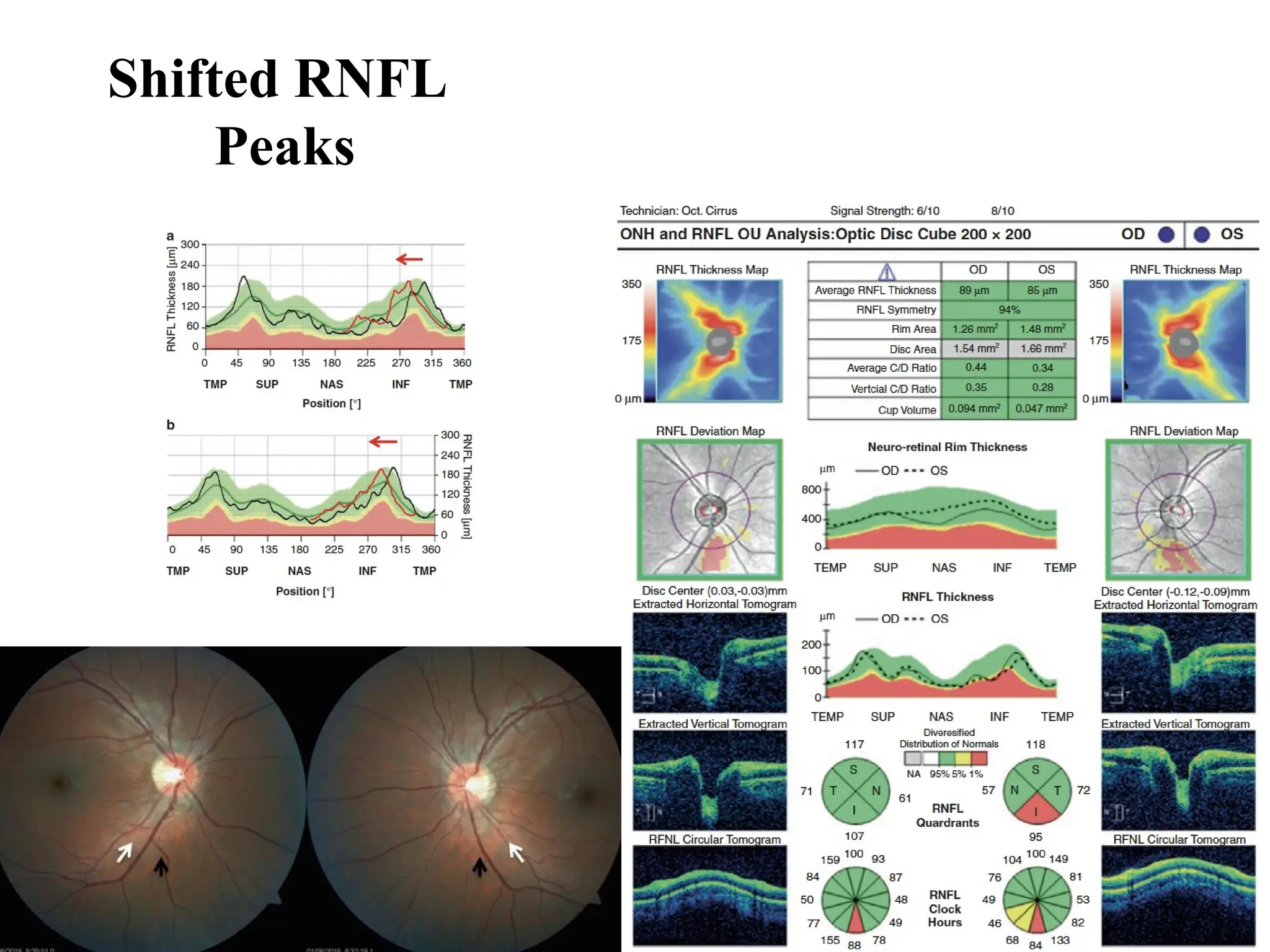 OCT in Glaucoma umesh- showing a Glaucoma | PPT