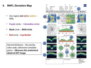 OCT in Glaucoma umesh- showing a Glaucoma | PPTX