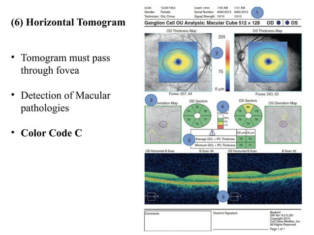 OCT in Glaucoma umesh- showing a Glaucoma | PPT