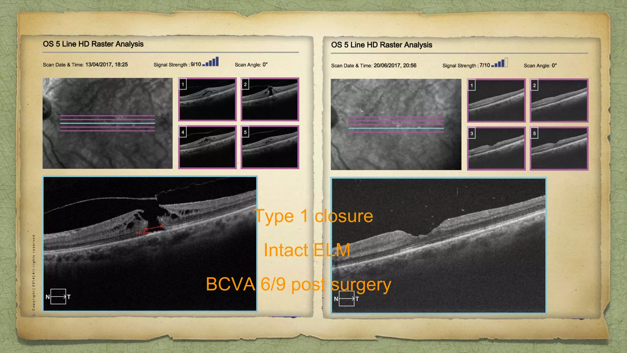 OCT IN MACULAR HOLES & ARMD | PPTX | Eye and Vision Conditions ...