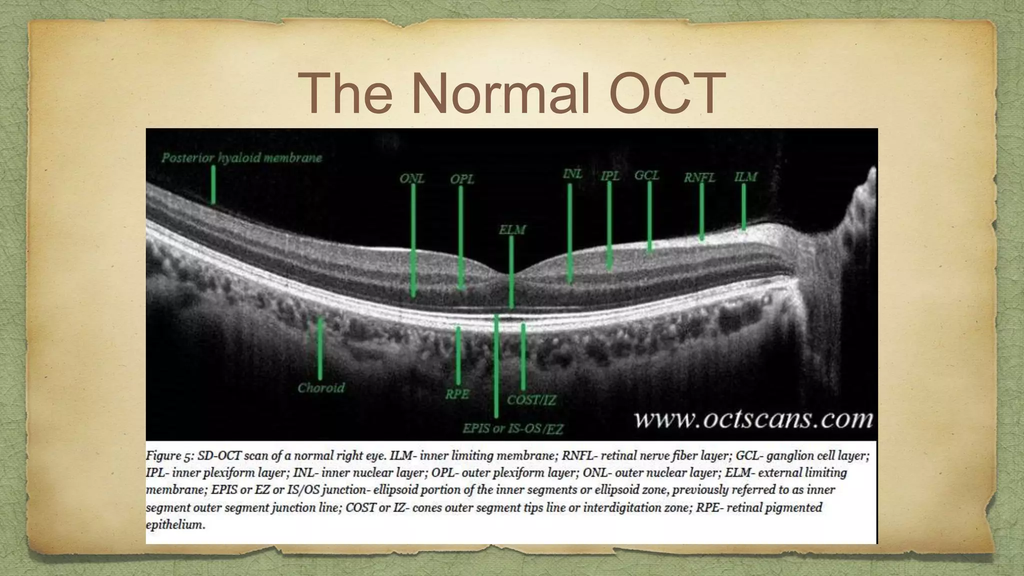 OCT IN MACULAR HOLES & ARMD | PPTX | Eye and Vision Conditions ...