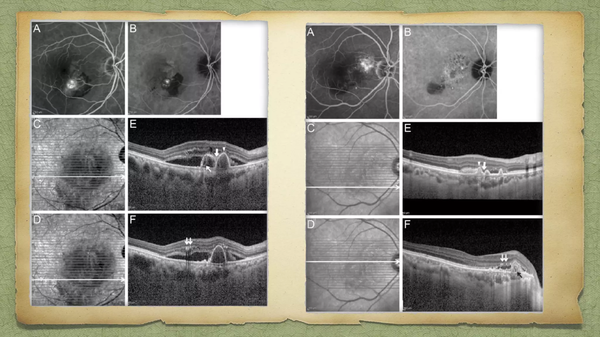 OCT IN MACULAR HOLES & ARMD | PPTX | Eye and Vision Conditions ...
