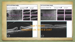 OCT IN MACULAR HOLES & ARMD | PPTX | Eye and Vision Conditions ...