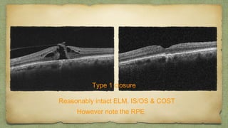 OCT IN MACULAR HOLES & ARMD | PPTX | Eye and Vision Conditions ...