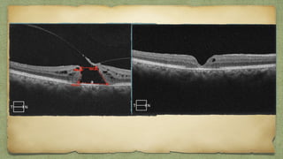 OCT IN MACULAR HOLES & ARMD | PPTX | Eye and Vision Conditions ...