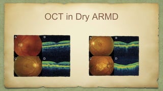OCT IN MACULAR HOLES & ARMD | PPTX