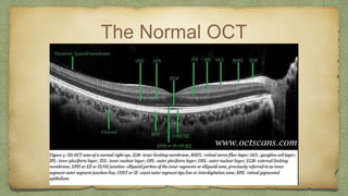 OCT IN MACULAR HOLES & ARMD | PPTX