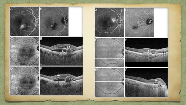 OCT IN MACULAR HOLES & ARMD | PPTX
