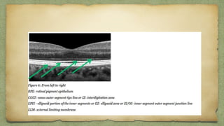 OCT IN MACULAR HOLES & ARMD | PPTX | Eye and Vision Conditions ...