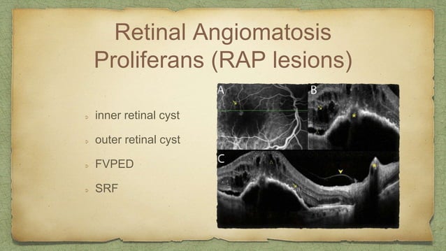 OCT IN MACULAR HOLES & ARMD | PPTX