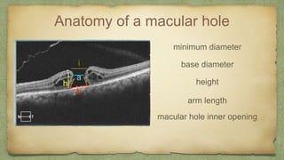 OCT IN MACULAR HOLES & ARMD | PPTX | Eye and Vision Conditions ...