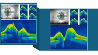 OCT Biomarkers in neuro-ophthalmic disorders | PPTX