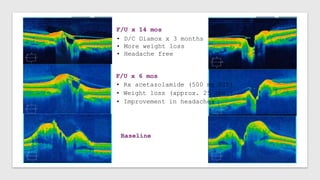 OCT Biomarkers in neuro-ophthalmic disorders | PPTX
