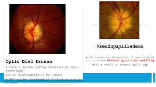 OCT Biomarkers in neuro-ophthalmic disorders | PPTX
