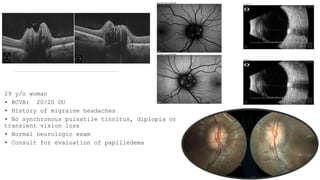 OCT Biomarkers in neuro-ophthalmic disorders | PPTX