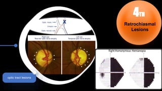 OCT Biomarkers in neuro-ophthalmic disorders | PPTX