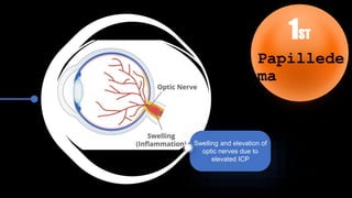 OCT Biomarkers in neuro-ophthalmic disorders | PPTX