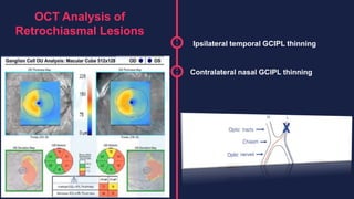 OCT Biomarkers in neuro-ophthalmic disorders | PPTX