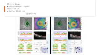 OCT Biomarkers in neuro-ophthalmic disorders | PPTX