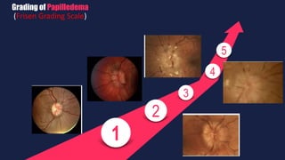 OCT Biomarkers in neuro-ophthalmic disorders | PPTX