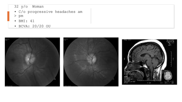OCT Biomarkers in neuro-ophthalmic disorders | PPTX | Eye and Vision ...