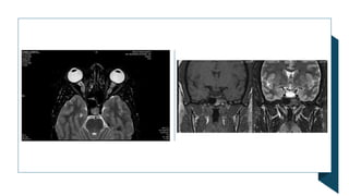OCT Biomarkers in neuro-ophthalmic disorders | PPTX