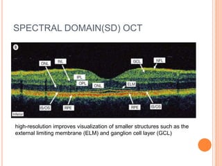 Optical Coherence Tomography(OCT) in posterior segment diseases | PPT
