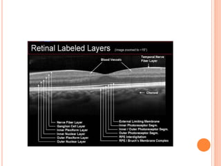 Optical Coherence Tomography(OCT) in posterior segment diseases | PPT