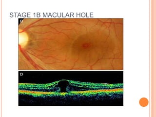 Optical Coherence Tomography(OCT) in posterior segment diseases | PPT