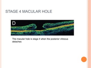 Optical Coherence Tomography(OCT) in posterior segment diseases | PPT