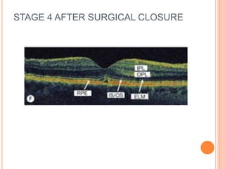 Optical Coherence Tomography(OCT) in posterior segment diseases | PPT
