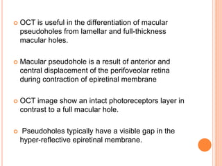 Optical Coherence Tomography(OCT) in posterior segment diseases | PPT