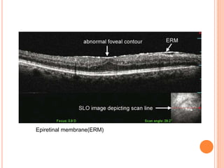 Optical Coherence Tomography(OCT) in posterior segment diseases | PPT