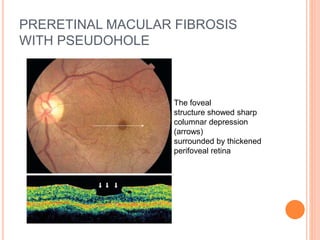 Optical Coherence Tomography(OCT) in posterior segment diseases | PPT