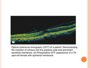 Optical Coherence Tomography(OCT) in posterior segment diseases | PPT