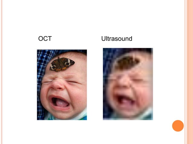 Optical Coherence Tomography(OCT) in posterior segment diseases | PPT