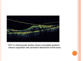 Optical Coherence Tomography(OCT) in posterior segment diseases | PPT