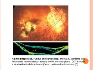 Optical Coherence Tomography(OCT) in posterior segment diseases | PPT