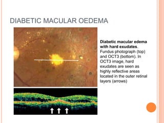 Optical Coherence Tomography(OCT) in posterior segment diseases | PPT