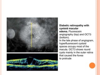Optical Coherence Tomography(OCT) in posterior segment diseases | PPT